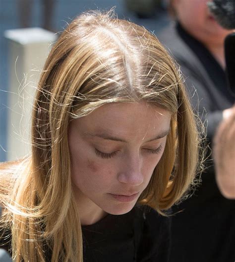 Sobbing And Bruised Amber Heard Granted Depp Restraining Order
