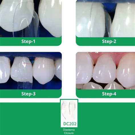 Bioclear Starter Matrix System Anterior Kit