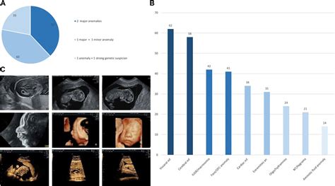 Frontiers Prenatal Diagnosis By Trio Exome Sequencing In Fetuses With Ultrasound Anomalies A