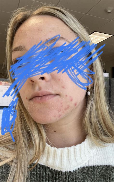 1 Year Tretinoin Journey R Tretinoin