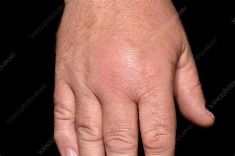 Gout Of The Big Toe Stock Image C0370907 Science Photo Library