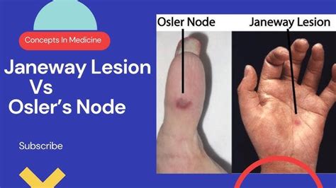 Janeway Lesions Hello Janeway Lesion