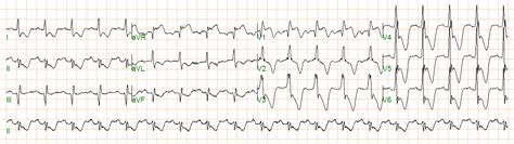 Is This Acute Ischemia More On Lvh Dr Smiths Ecg Blog