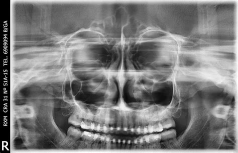 Radiografías Extraorales Rxm Radiologia Maxilofacial