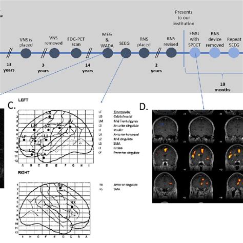 Seeg Implantation And Ictal Seeg Pattern A Schematic Of The Seeg Plan Download Scientific Seeg Implantation And Ictal Seeg Pattern A Schematic Of The Seeg Plan Download Scientific