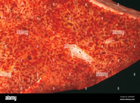 Inflamed Liver Gross Clinical Specimen Of A Sectioned Liver With