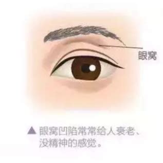 整形医生王昕 的想法 上睑凹陷的原因有哪些 1先天性上睑脂 知乎
