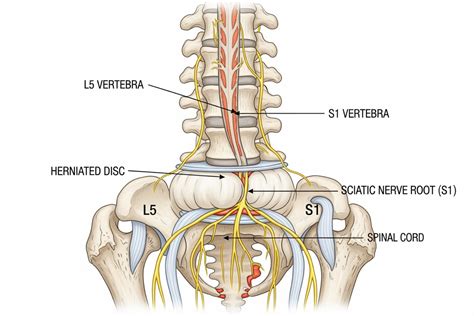 Sciatica Pain Relief In 5 Simple Steps Neuropasil
