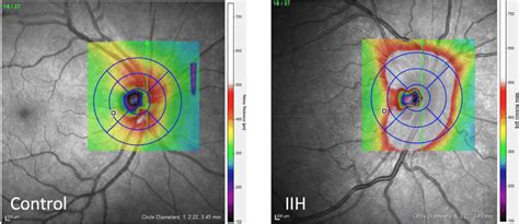 Optical Coherence Tomography Oct Imaging Of The Optic Nerve Head Download Scientific Diagram