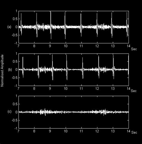 A Raw Surface Respiratory Emg Signal Contaminated With Ecg And Power Download Scientific