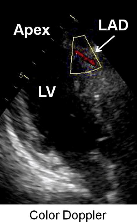Transthoracic Color Doppler Echocardiogram Showing Coronary Blood Flow Download Scientific