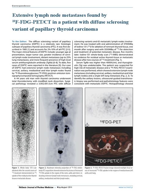 Diffuse Sclerosing Variant Of Papillary Thyroid Carcinoma Pdf Metastasis Clinical Medicine