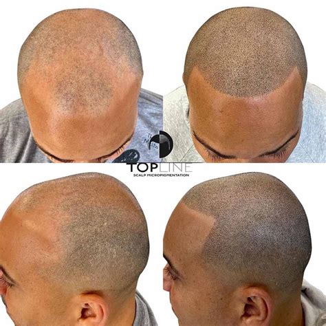 Scalp Micropigmentation Aftercare Guide Day By Day