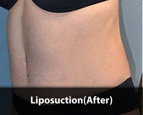 What To Expect From Abdominoplasty With Liposuction Grand Genesis