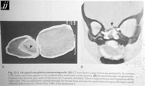 Ent Posterior Meningoencephalocele And Cribriform Defect Radioogle