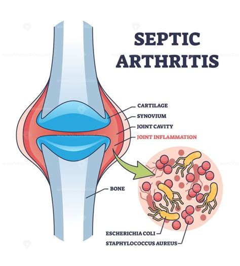 Septic Arthritis Joint Inflammation With Medical Explanation Outline