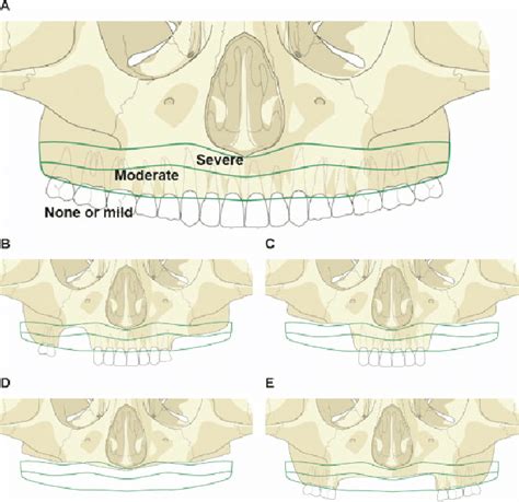 Illustration Of Maxilla Edentulism And Atrophy A “ Atrophy Grid