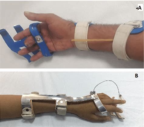 Dynamic Mobilization Splints Used In Patients With Flexor A And
