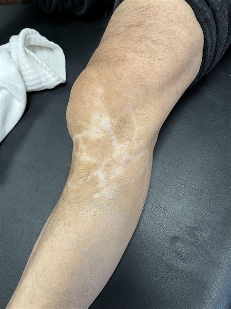 Uvula Swelling And White Spot I Thought I Had Strep Been On