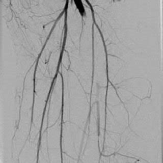 External Fixation Of Proximal Tibia Fractures Request PDF
