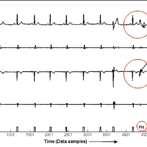 Qrs Detection In Record No 201 Of Mit Bih Arrhythmia Database Download Scientific Diagram