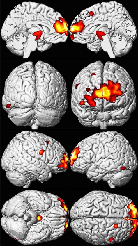 Sex Influences Brain Volume Loss Associated With Lead Exposure Males Download Scientific