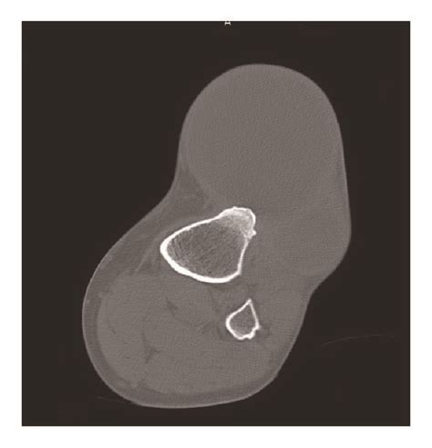 61 Year Old Male With A Subcutaneous Chronic Expanding Hematoma In The