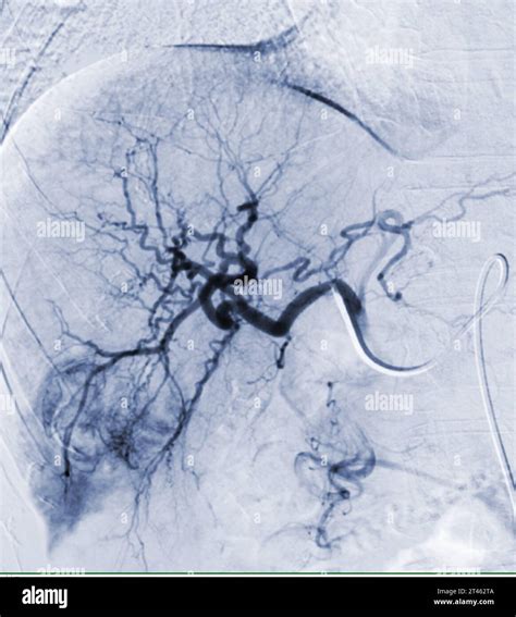 Transarterial Chemoembolization Tace Is A Medical Procedure Used To The Treatment Of
