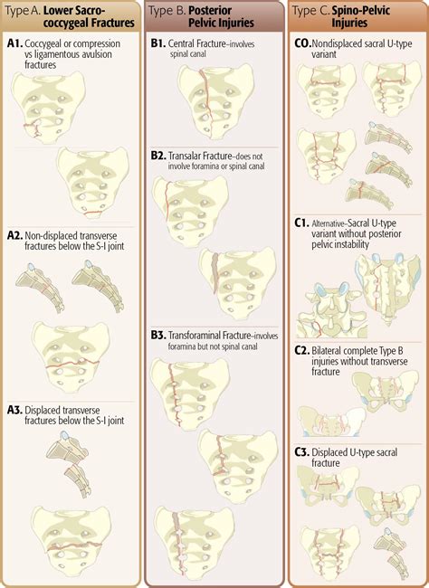 Sacral Fractures Clinical Tree