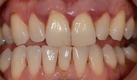 Gums Receding Behind Teeth At Garry Beckwith Blog
