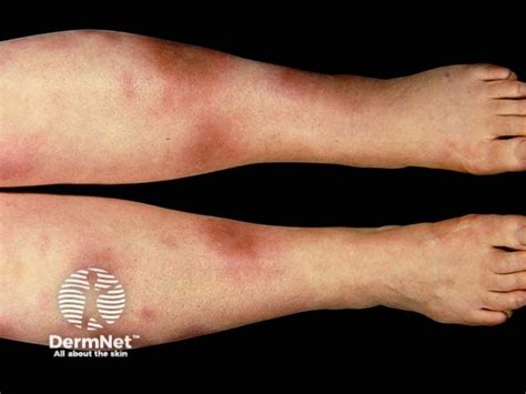 Sarcoidosis Symptoms Causes And Images Dermnet