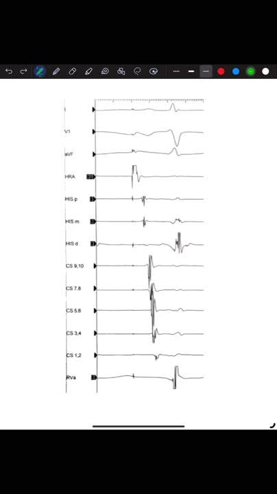 Dont Miss The His On Linkedin Electrogram Eplab Monitoring Invasivecardiology