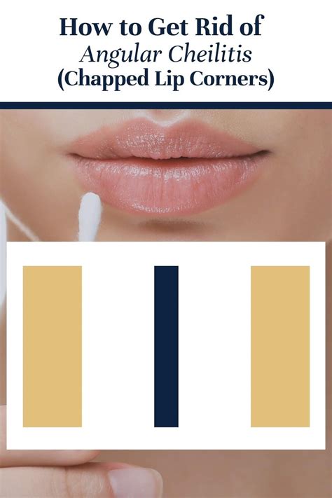 Angular Cheilitis Review Angular Cheilitis Home Remedy Artofit