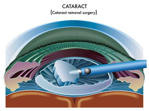 Cataract Surgery Diagram Mr Shahram Kashani