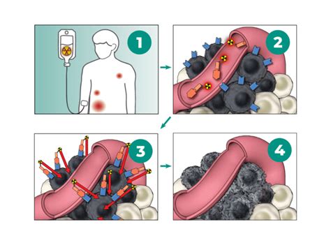Ara Administers Prostate Cancer Treatment With Lu 177 Psma Pluvicto