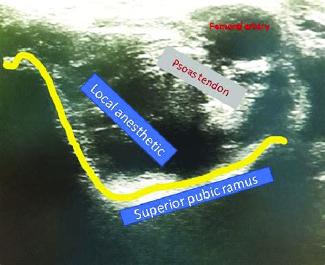 Ultrasound Image After Administration Of The Pericapsular Nerve Group Download Scientific