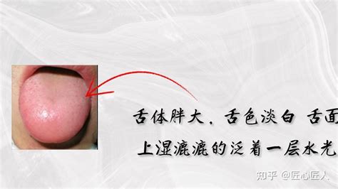 裂纹舌、齿痕舌、胖大舌分别代表了什么？ 知乎