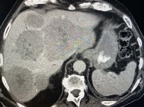 Liver Masses On Ct Scan Radiology In Plain English