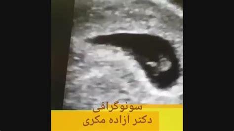 ️سونوگرافى جنین شش هفته و شش روز ️ نماشا
