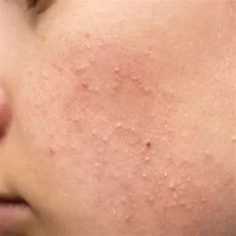 5 Retinol Side Effects A Comprehensive Guide Catwalk