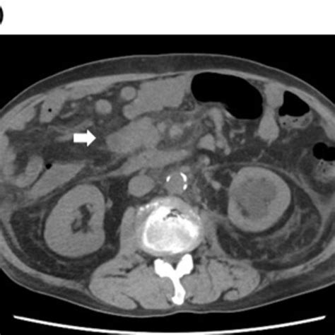 Abdominal Ct Image Showing Mesenteric Metastasis Arrow A Note That