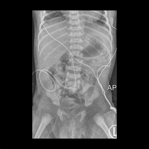 Premature Newborn After PICC Placement Pediatric Radiology Case Pediatric Imaging