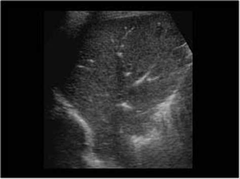 Thorax 81 Pulmonary Pathology Case 811 Pneumonia And Air Space