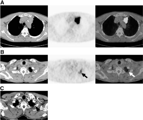 Thymic Squamous Carcinoma At Verna Bixler Blog