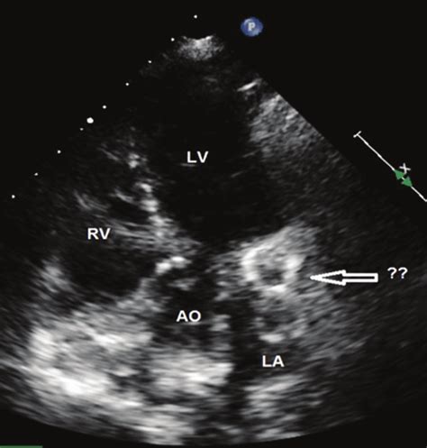 The Amplatzer Cardiac Plug Device Is An Alternative Non Surgical Method