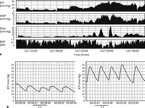 Baseline Icp Monitoring A Initial Recordings Showed Increased Mean Icp Download Scientific