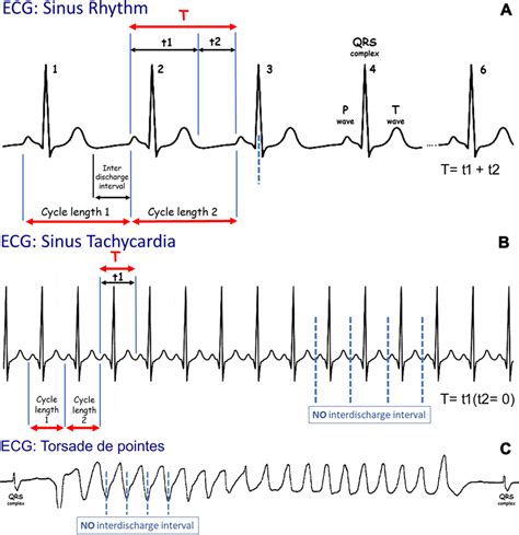 Comparison Between Sinus Rhythm A And Sinus Tachycardia B In This
