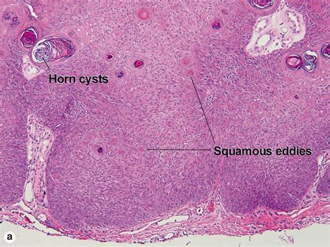 Benign Tumors And Cysts Of The Epidermis Clinical Tree