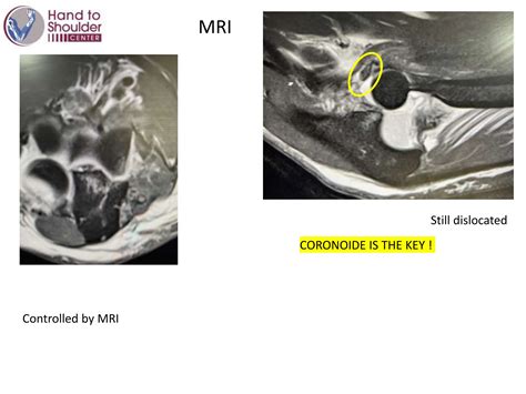 Coronoid Fracture Fix Or Not Pptx