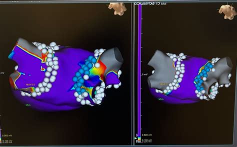 Pvi And Atypical Atrial Flutter Mid Diastolics With Slowing Down And